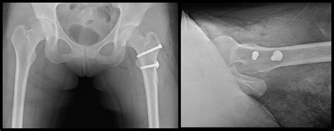 Surgical Hip Dislocation