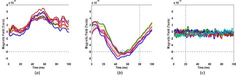 Figure 1 From Epileptic Meg Spikes Detection Using Amplitude Thresholding And Dynamic Time