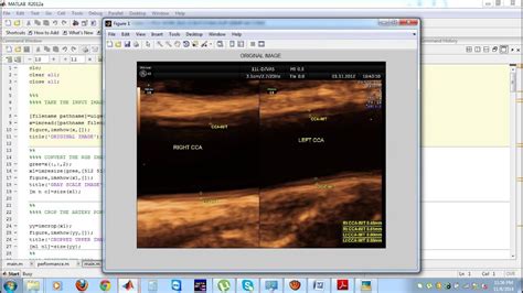 Sd Ieee Matlab Robust Carotid Artery Recognition In Longitudinal B Mode