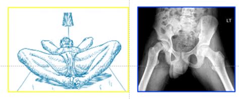 Le Imaging Hip Flashcards Quizlet