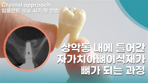 한국치아은행 105 상악동 내에 들어간 자가치아뼈이식재가 뼈가 되는 과정뼈이식 임플란트 수술시기과정엄인웅박사 Youtube