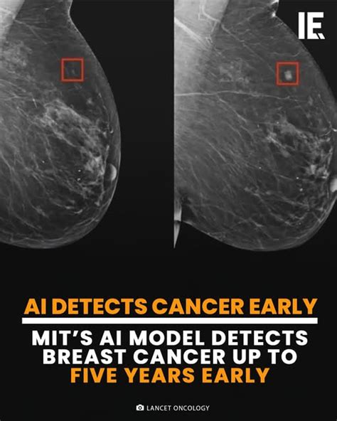 Mirai Revolutionary Ai Model For Early Breast Cancer Detection” Thermooncology