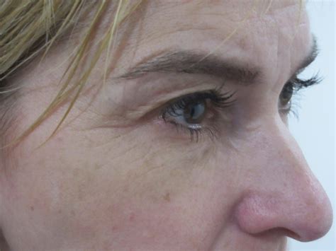 Non Surgical Blepharoplasty Dr Sw Clinics