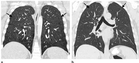 Mosaic Attenuation With Ground Glass Opacity And Upper Lobe