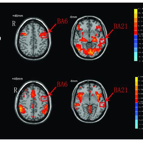 T Score Map Showing The Brain Areas Activated During Both Ao And Ae