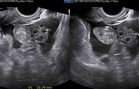 Vnotes Hysterectomy Technique In A Case With Big Broad Ligament Fibroid Video Article Isge