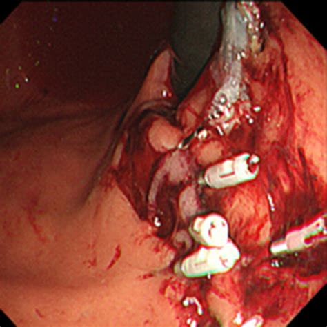 Repairment Of Perforation With Clips Download Scientific Diagram