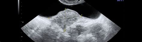 Laparoscopic Surgery Melaka Fertility