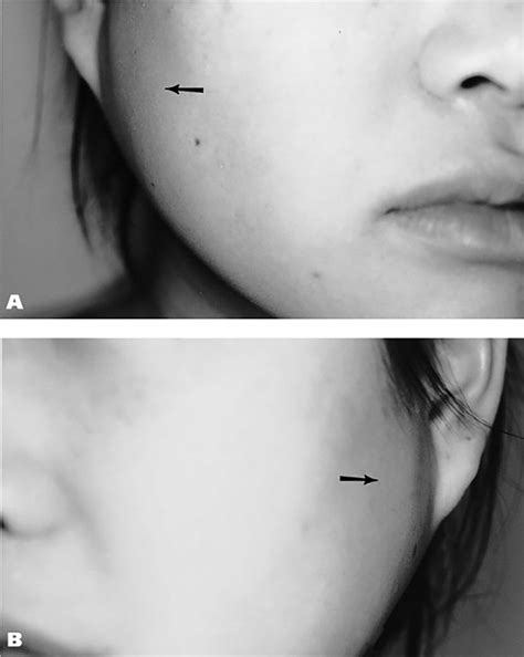 Diagnosing Bulimia Nervosa With Parotid Gland Swelling The Journal Of