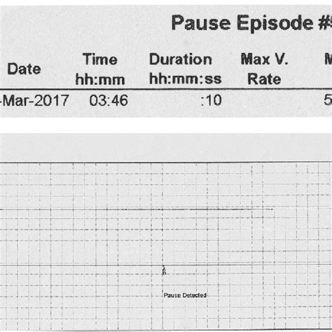 Sinus Pause Of 10 Seconds That Coincided With A Syncopal Event As