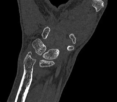 Ulnar Styloid Fracture Image Radiopaediaorg Fracture Severity And