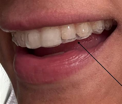 Retainer Fit Does This Look Normal Rinvisalign