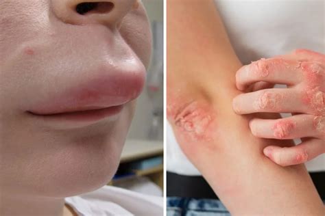 Hives And Angioedema Symptoms Causes And Treatment