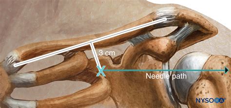 Infraclavicular Brachial Plexus Block Landmarks And Nerve Stimulator Technique Nysora