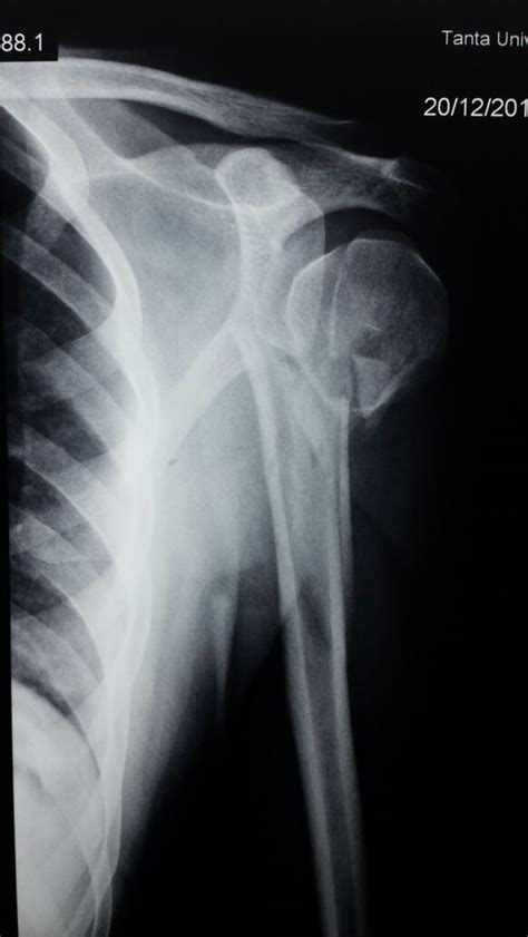 Proximal Humerus Fractures Trauma Orthobullets