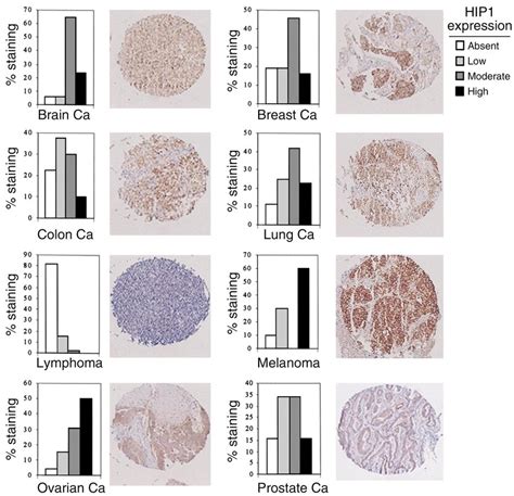 Immunohistochemical Analysis Of The Multitumor Tissue Microarray Tarp1 Download Scientific