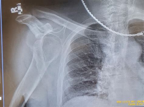 If You Struggle With Scap Y Lateral Scapula R Radiology