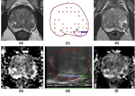 Figure 6 From Pi Rads Version 2 What You Need To Know Semantic Scholar