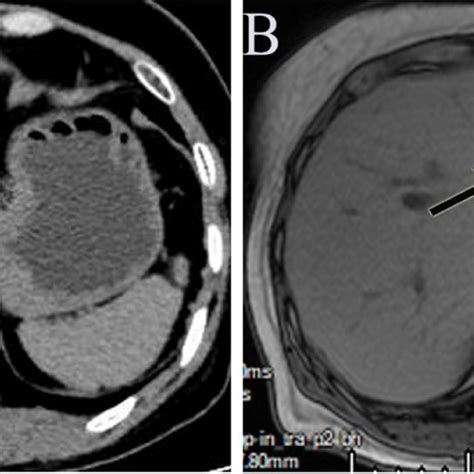 Preoperative Imaging Workup Of Left Intrahepatic Bile Duct Calculi And Download Scientific