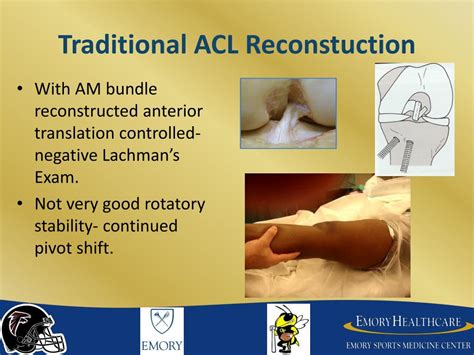 PPT ACL Reconstruction The Anatomic Approach PowerPoint Presentation ID