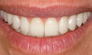 Gummy Smiles What Causes A Gummy Smile