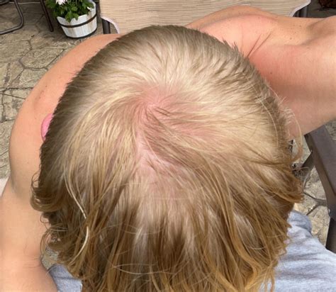 Derm Thinks Its Seb Derm… Its Been Itching And Shedding Like Crazy R Sebderm