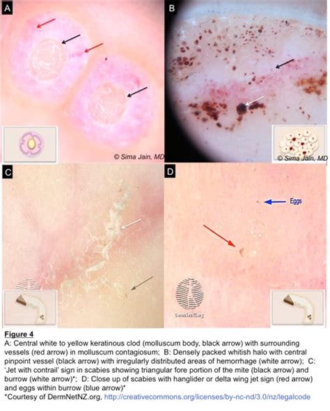 Practical Dermoscopy Part 2 Next Steps In Dermatology