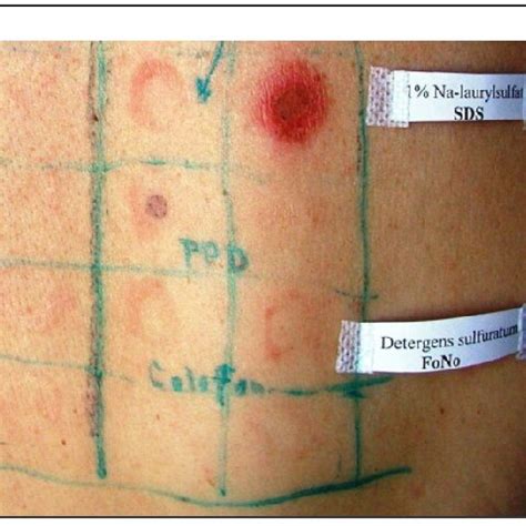 Patch Test Performed To Prove SDS Hypersensitivity In A Year Old Download Scientific Diagram