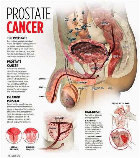 The Truth About Prostate Cancer