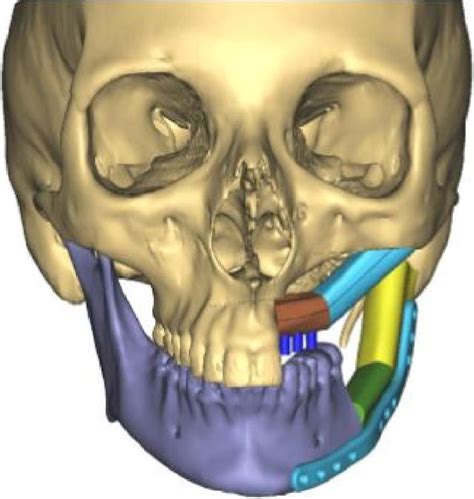 Example Of A Virtual Plan With The Mandibular And Maxillary Defect And Download Scientific