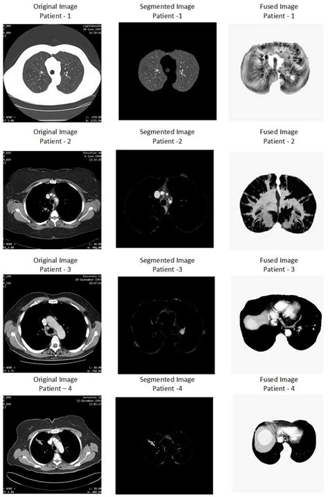 Efficient Pre Processing And Segmentation For Lung Cancer Detection