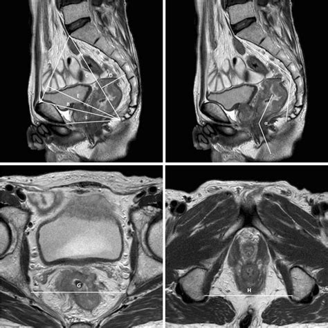 Mri Based Pelvimetry A Pelvic Inlet B Pubococcygeal Distance C Download Scientific