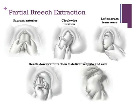 Ppt Breech Presentation Powerpoint Presentation Free Download Id 6051090