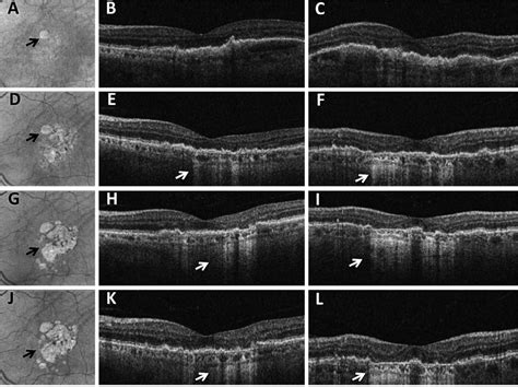 Macular Atrophy Skin