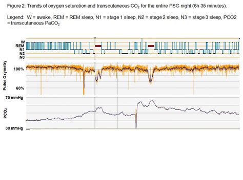 Sleep Disordered Breathing In Chronic Obstructive Pulmonary Disease Copd