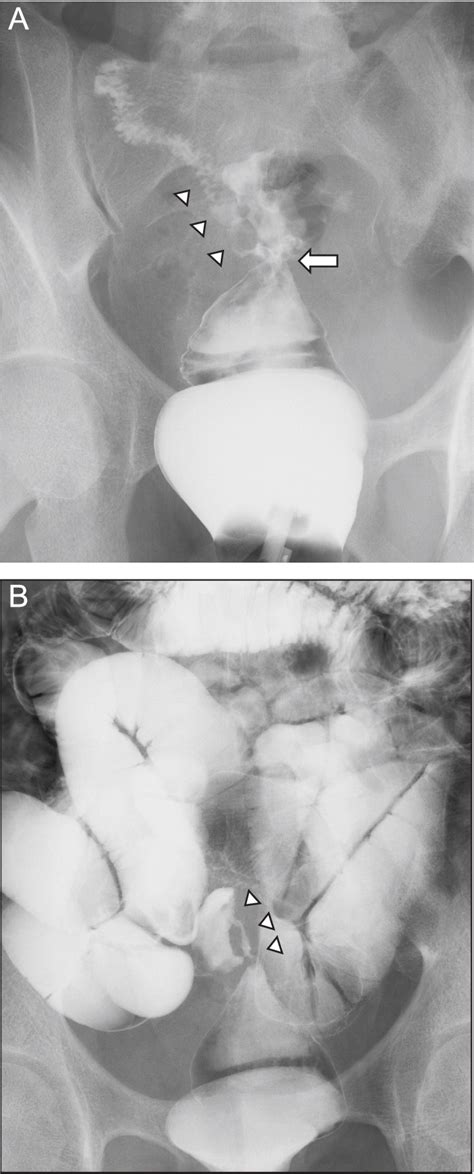 Figure 1 From Ileal Interposition Reconstruction For Ileo Rectal