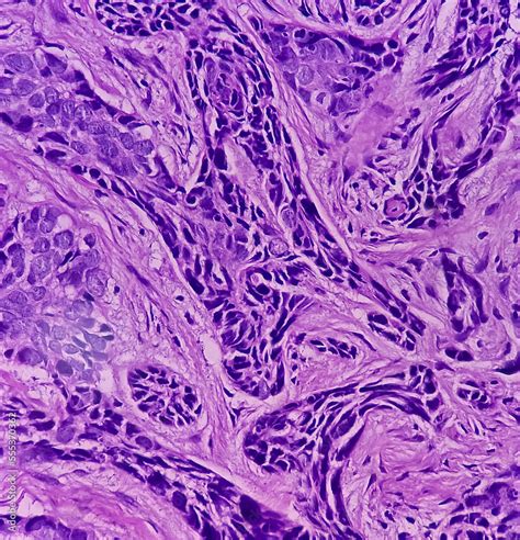 Poster Basal Cell Carcinoma Show Skin Malignant Neoplasm Of Atypical