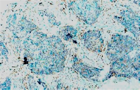 Tonsillar Biopsy Mdscc Ihc Staining For Bcl 2 Positive Score 1