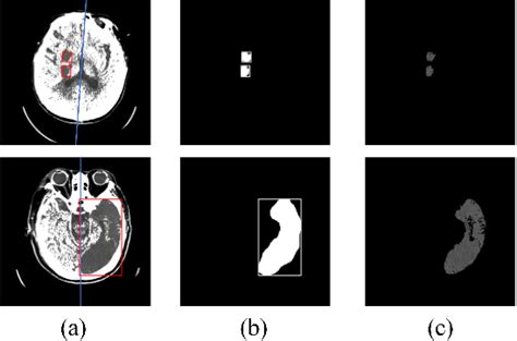 Figure 4 From Is Net Automatic Ischemic Stroke Lesion Segmentation On Ct Images Semantic Scholar
