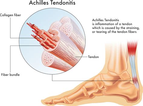 Tendons A Cornerstone For Movement How Does Research Help Heal Injuries