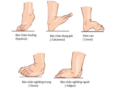 Dị Tật Bàn Chân Vẹo Cách điều Trị Và Phòng Ngừa Dị Tật