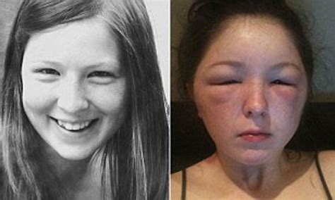 Allergic Reaction Face Swelling