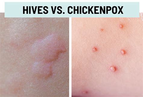 Hives Urticaria Vs Rash Pictures And Differences
