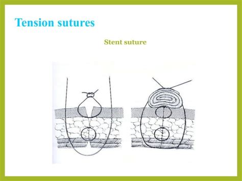 Basic Suture Patterns