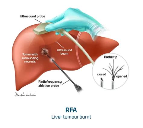 Radiofrequency Ablation Rfa For Liver Tumours Dr Harsh J Shah