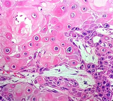 Kiman Making Pathology Simple Diagnostic Indicators Of Squamous