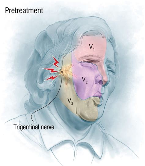 Trigeminal Neuralgia Intraoperative Vs Imaging Evidence