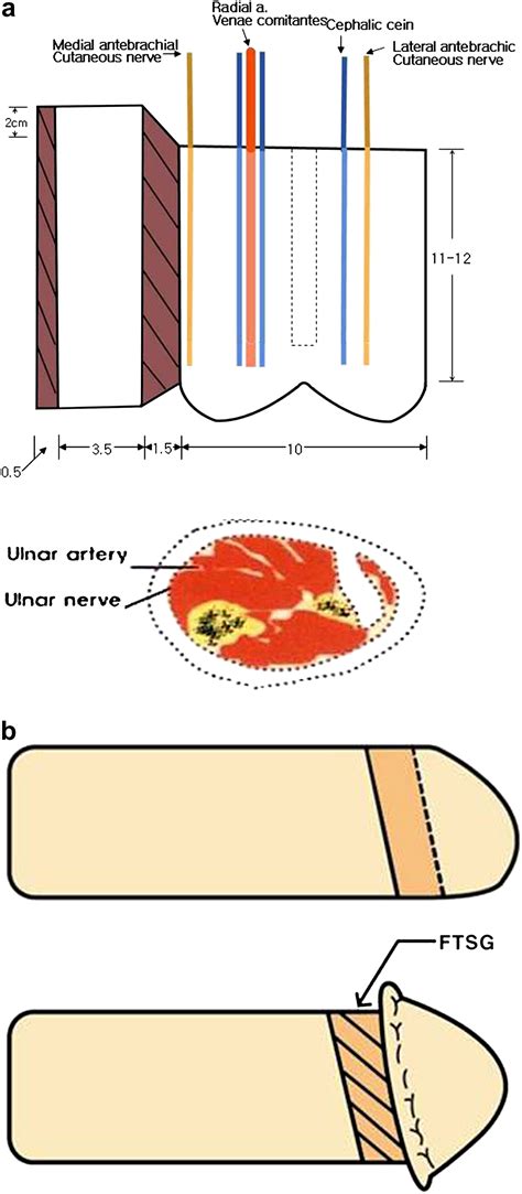 Phalloplasty Using Radial Forearm Osteocutaneous Free Flaps In Female