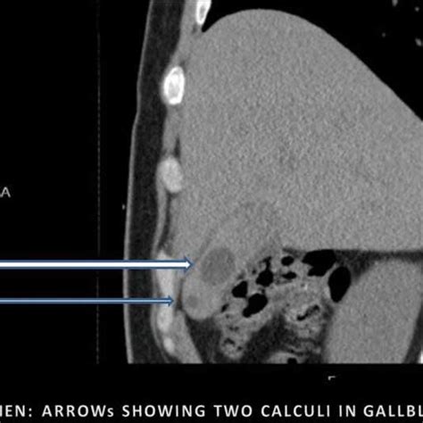 Ct Scan Abdomen Arrows Showing Large Gallbladder Calculas With