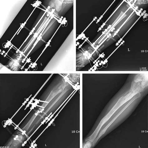 Type Iii Fibular Hemimelia Is Shown In This Radiograph Download
